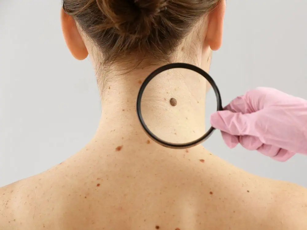 Nelson Tasman Skin Check Vouchers - Cancer Society
